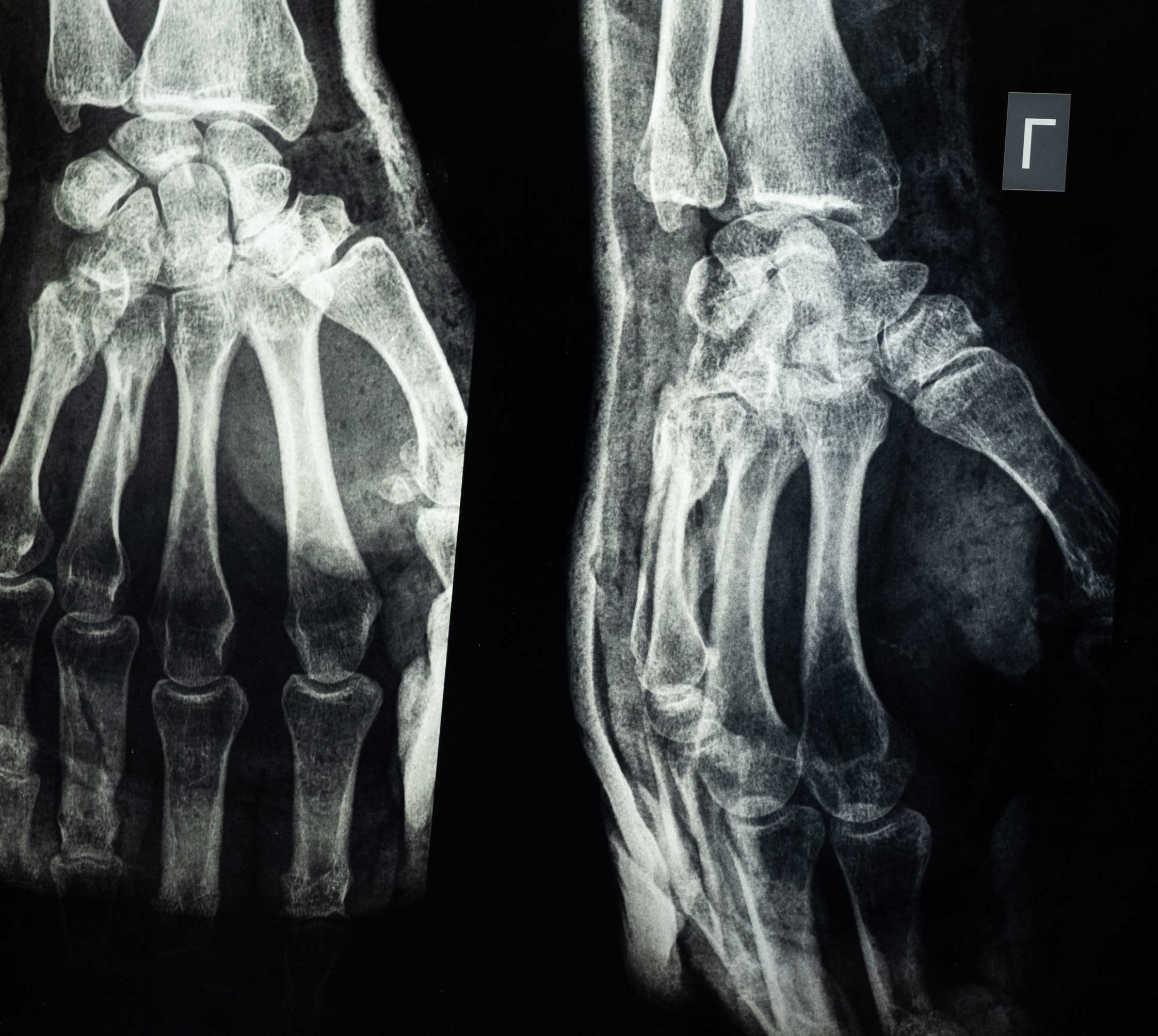 Radiografia età ossea (mano – polso) – Studio di radiologia Delta RX